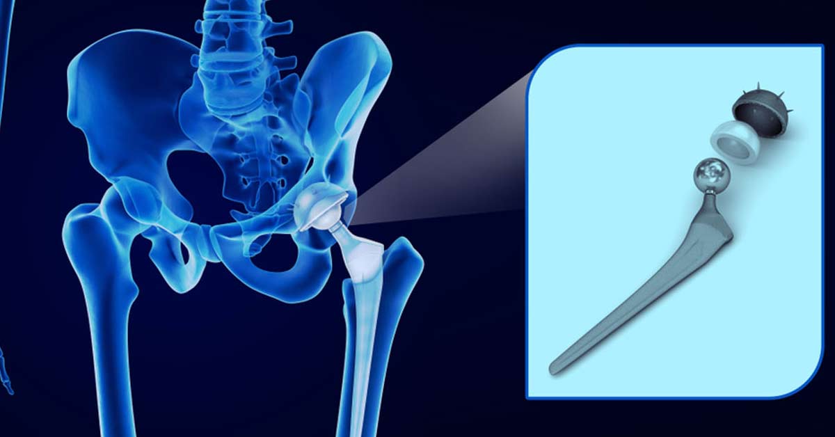 Prótese de Quadril: O Que Saber Antes da Cirurgia?